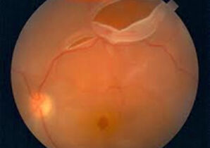 Signs of retinal detachment - Eye Max Centre