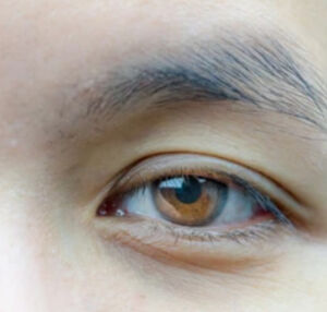 Droopy eyelids (ptosis) - Eye Max Centre