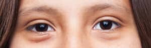 Excess Skin on Eyelid | Blepharoplasty Surgery in Singapore
