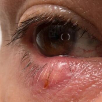 Eyelid lump and tumour - Eye Max Centre