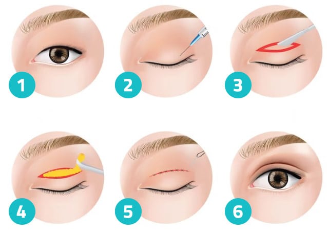 Most Common Causes & Possible Treatments for Eye Stye in Singapore