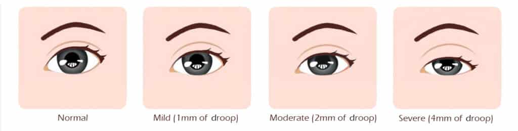 Droopy eyelids (ptosis) , Surgery | Eye Max Centre Singapore
