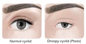 Droopy eyelids (ptosis) , Surgery | Eye Max Centre Singapore